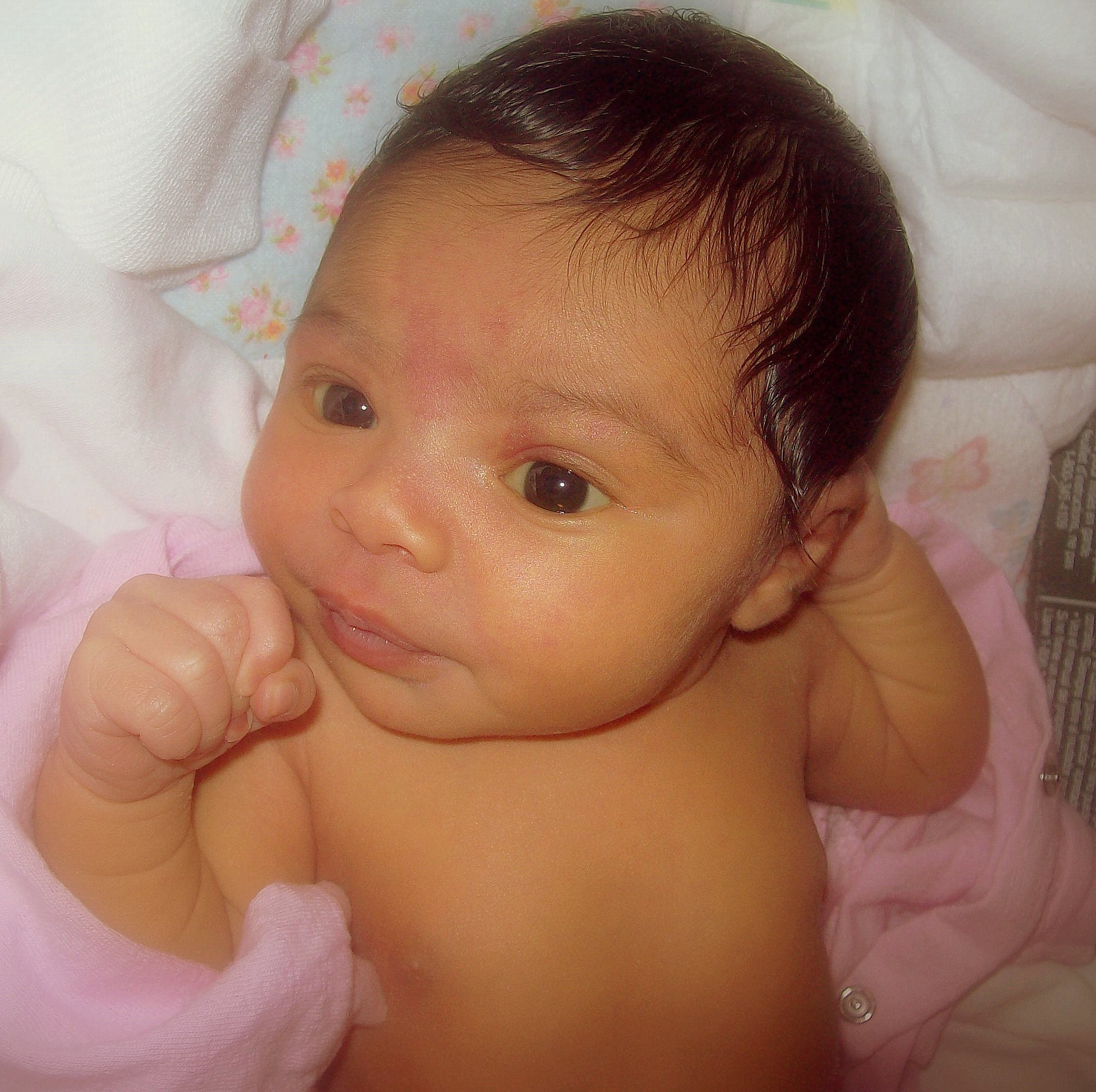 Jaundice In The Breastfed Baby Jaundice In The Breastfed Baby